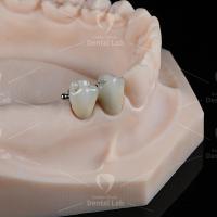 China PFM Ball Abutments Dental Implants Precision Attachment Tissue Friendly for sale