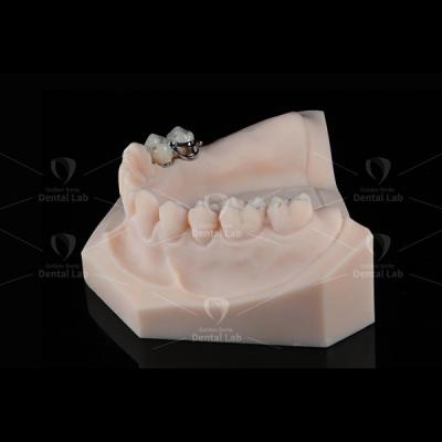 China PFM Ball Abutments Dental Implants Precision Attachment Tissue Friendly for sale