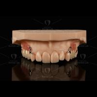 China Natural Look Removable Dentures Acrylic Partial Denture Y Clasp + Wire Clasp for sale