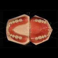 China Precision Engineered Acrylic Full Denture Removable Acrylic Complete Denture for sale