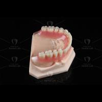 China Lightweight Pink Clear Flexible Denture Vertex Flexible Partials for sale