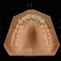 China Co-Cr PFM Bridge Cobalt Chrome Alloy Dental Bridge Full Crown Restoration for sale