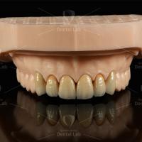 China Co-Cr PFM Bridge Cobalt Chrome Alloy Dental Bridge Full Crown Restoration for sale