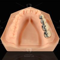 China Dental PFM Bridge Lingual And Occlusal Metal Including Cusp Buccal Only Porcelain for sale