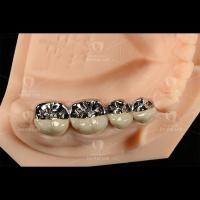 China Dental PFM Bridge Lingual And Occlusal Metal Including Cusp Buccal Only Porcelain for sale