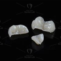 China Natural Composite Inlays And Onlays Ceramic Crown Dental Inlay Onlay Biocompatibility for sale