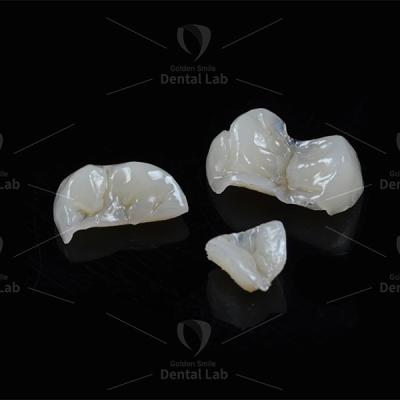 China Natural Composite Inlays And Onlays Ceramic Crown Dental Inlay Onlay Biocompatibility for sale