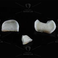 China Natural Composite Inlays And Onlays Ceramic Crown Dental Inlay Onlay Biocompatibility for sale