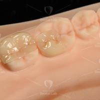 China High Strength Zirconia Inlay Onlay Zirconia Restorations CAD / CAM Digital Milling for sale