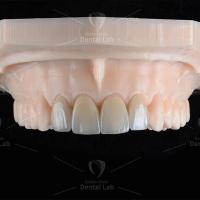 China Aesthetic Dental Zirconia Veneer High Translucency Zirconium Oxide Dental for sale