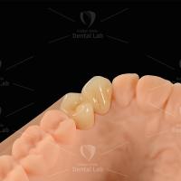 China E Max Bridge Emax Laminate Veneers Lithium Disilicate Glass Ceramic Material for sale