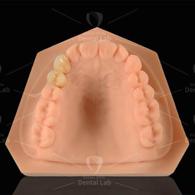China E Max Bridge Emax Laminate Veneers Lithium Disilicate Glass Ceramic Material for sale