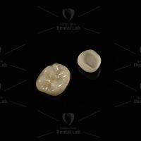 China Lithium Disilicate Ceramic Full E.Max Onlay Emax Restorations High Pressure Resistance for sale