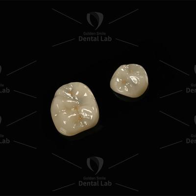 China Lithium Disilicate Ceramic Full E.Max Onlay Emax Restorations High Pressure Resistance for sale