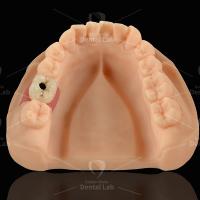 China PFM Dental Implant Bridge Co-Cr Screw Retained Bridge CAD CAM Designed for sale