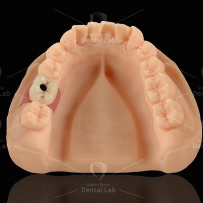 China PFM Dental Implant Bridge Co-Cr Screw Retained Bridge CAD CAM Designed for sale
