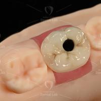 China PFM Dental Implant Bridge Co-Cr Screw Retained Bridge CAD CAM Designed for sale