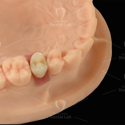 China Cement Retained Zirconia Implant Crown And Bridge Dental Lab for sale