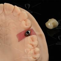 China Cement Retained Zirconia Implant Crown And Bridge Dental Lab for sale