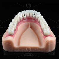 China Implant PFM Crown Co-Cr Screw Retained Dental Crown And Bridge for sale