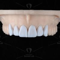 China Dental Crown Wax Up Preparation Single Tooth Implants Diagnostic Waxup for sale
