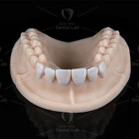 China Non Prep Diagnostic Wax Up For Veneers Rehab Full Mouth Wax Up for sale
