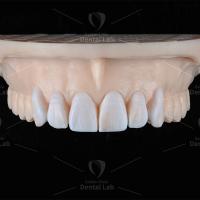 China Non Prep Diagnostic Wax Up For Veneers Rehab Full Mouth Wax Up for sale
