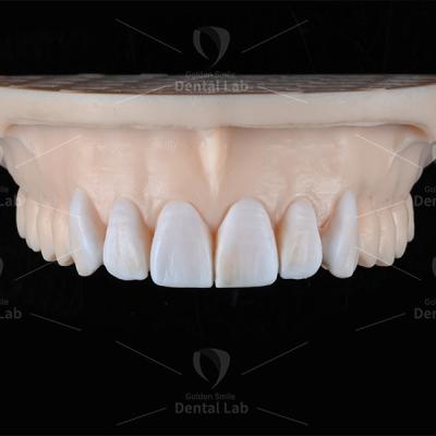 China Non Prep Diagnostic Wax Up For Veneers Rehab Full Mouth Wax Up for sale