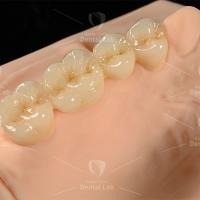 China CAD/CAM Dental Zirconia Bridge Medical Grade Layered Zirconia Bridge for sale