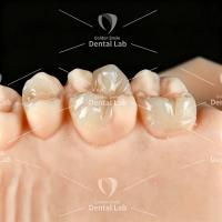 China All-ceramic inlay  Natural tooth shade  Dental Inlay  Biocompatibility  Minimally-invasive dental restoration for sale