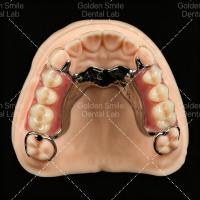 China Custom Co-Cr Metal Framework Partial Denture , Acrylic Base With Metal, Acetal resin clasps for sale