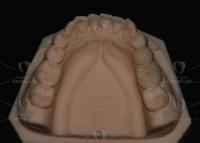 China Lithium Disilicate Pressed Ceramic Onlays with Biocompatibility, Natural Aesthetics, and High Strength for Posterior Teeth Restoration for sale