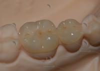China Lithium Disilicate Pressed Ceramic Onlays with Biocompatibility, Natural Aesthetics, and High Strength for Posterior Teeth Restoration for sale