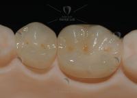 China Lithium Disilicate Pressed Ceramic Onlays with Biocompatibility, Natural Aesthetics, and High Strength for Posterior Teeth Restoration for sale