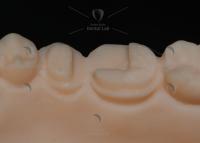 China Lithium Disilicate Pressed Ceramic Onlays with Biocompatibility, Natural Aesthetics, and High Strength for Posterior Teeth Restoration for sale