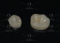 China Lithium Disilicate Pressed Ceramic Onlays with Biocompatibility, Natural Aesthetics, and High Strength for Posterior Teeth Restoration for sale