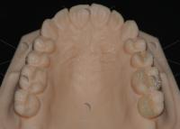 China Biocompatible Lithium Disilicate Pressed Ceramic Inlays with Natural Aesthetics for Minimally-invasive Dental Restoration for sale