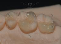China Biocompatible Lithium Disilicate Pressed Ceramic Inlays with Natural Aesthetics for Minimally-invasive Dental Restoration for sale