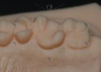 China Biocompatible Lithium Disilicate Pressed Ceramic Inlays with Natural Aesthetics for Minimally-invasive Dental Restoration for sale
