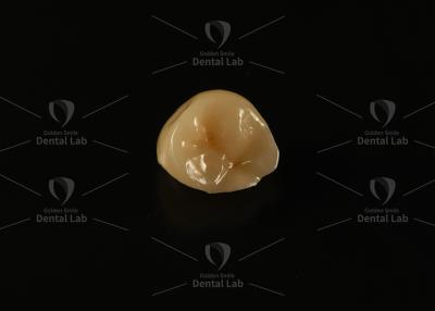China Custom Metal-free Full-Zirconia Crown and Inlay with High Fracture Resistance and Precise Marginal Fit for sale