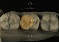 China Custom Metal-free Full-Zirconia Crown and Inlay with High Fracture Resistance and Precise Marginal Fit for sale