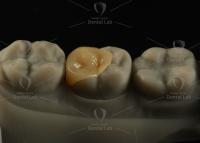 China Custom Metal-free Full-Zirconia Crown and Inlay with High Fracture Resistance and Precise Marginal Fit for sale