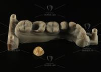China Custom Metal-free Full-Zirconia Crown and Inlay with High Fracture Resistance and Precise Marginal Fit for sale