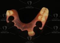 China Flexible Partial Dentures with Invisible Clasp, Fracture-resistant & Aesthetic Restoration for Metal-allergic Patients for sale
