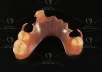 China Flexible Partial Dentures with Invisible Clasp, Fracture-resistant & Aesthetic Restoration for Metal-allergic Patients for sale