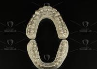 China Custom-made Clear Retainer Virtually Invisible Dental Retainer Made of Medical-grade Thermoplastic for sale