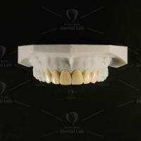 China EMAX Lithium Disilicate Veneers Natural Aesthetic China Dental Lab for sale