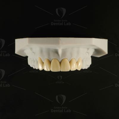 China EMAX Lithium Disilicate Veneers Natural Aesthetic China Dental Lab for sale