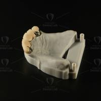 China Precision Ball Attachment Removable Partial Denture China Dental Lab for sale