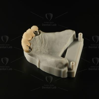 China Precision Ball Attachment Removable Partial Denture China Dental Lab for sale